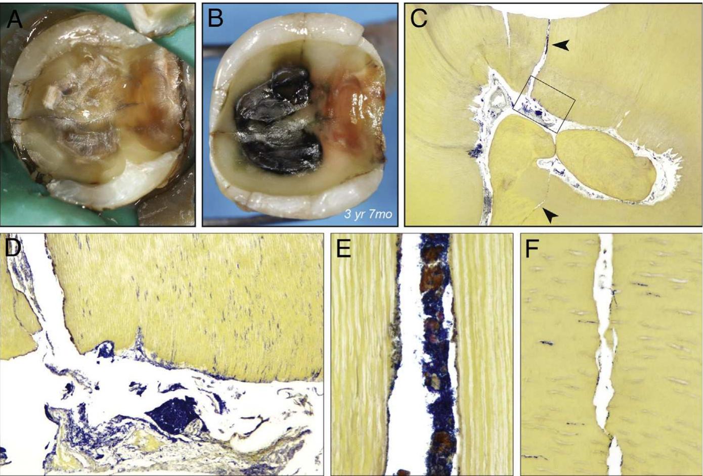 The mandibular third molar of a 77-year-old woman after the