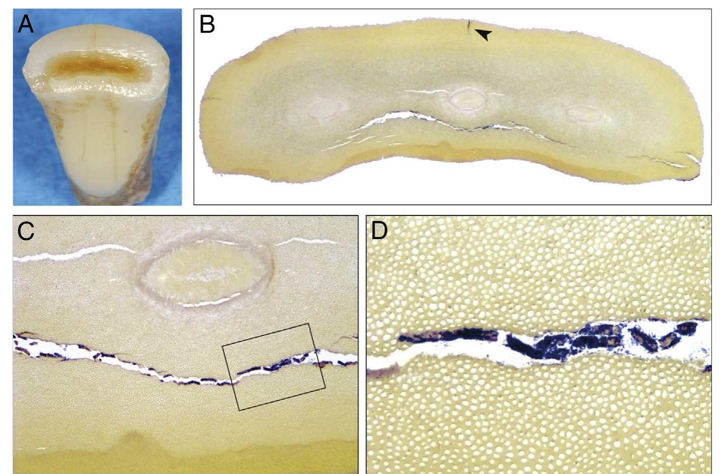 (4) the mandibular central incisor of a 65-year-old woman
