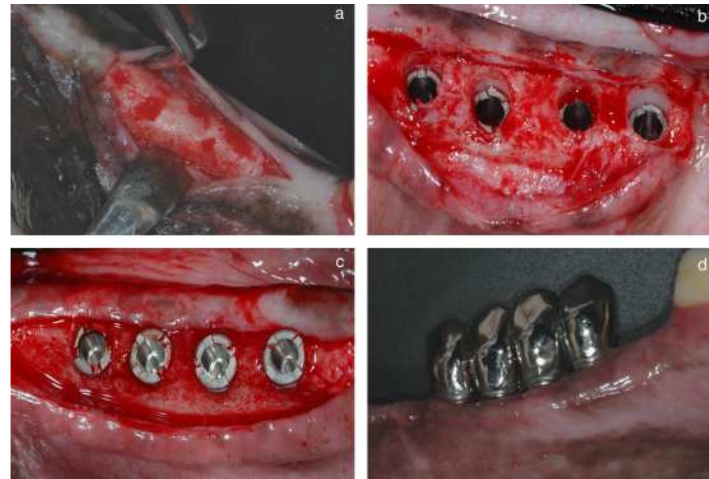 (a) alveolar sockets completely healed and ready to receive