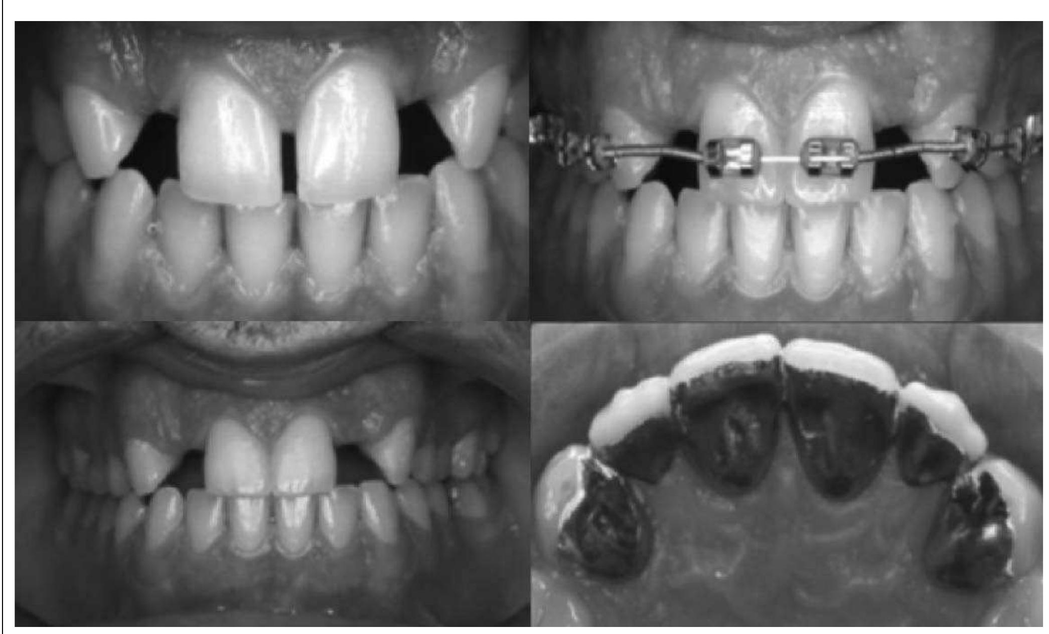 Management of the maxillary midline diastema, caused by