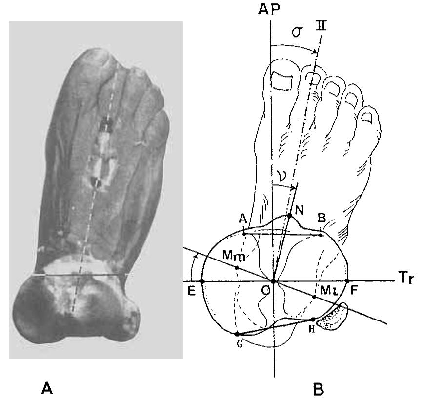 (a) axial view of the tibia and foot. alignment of the