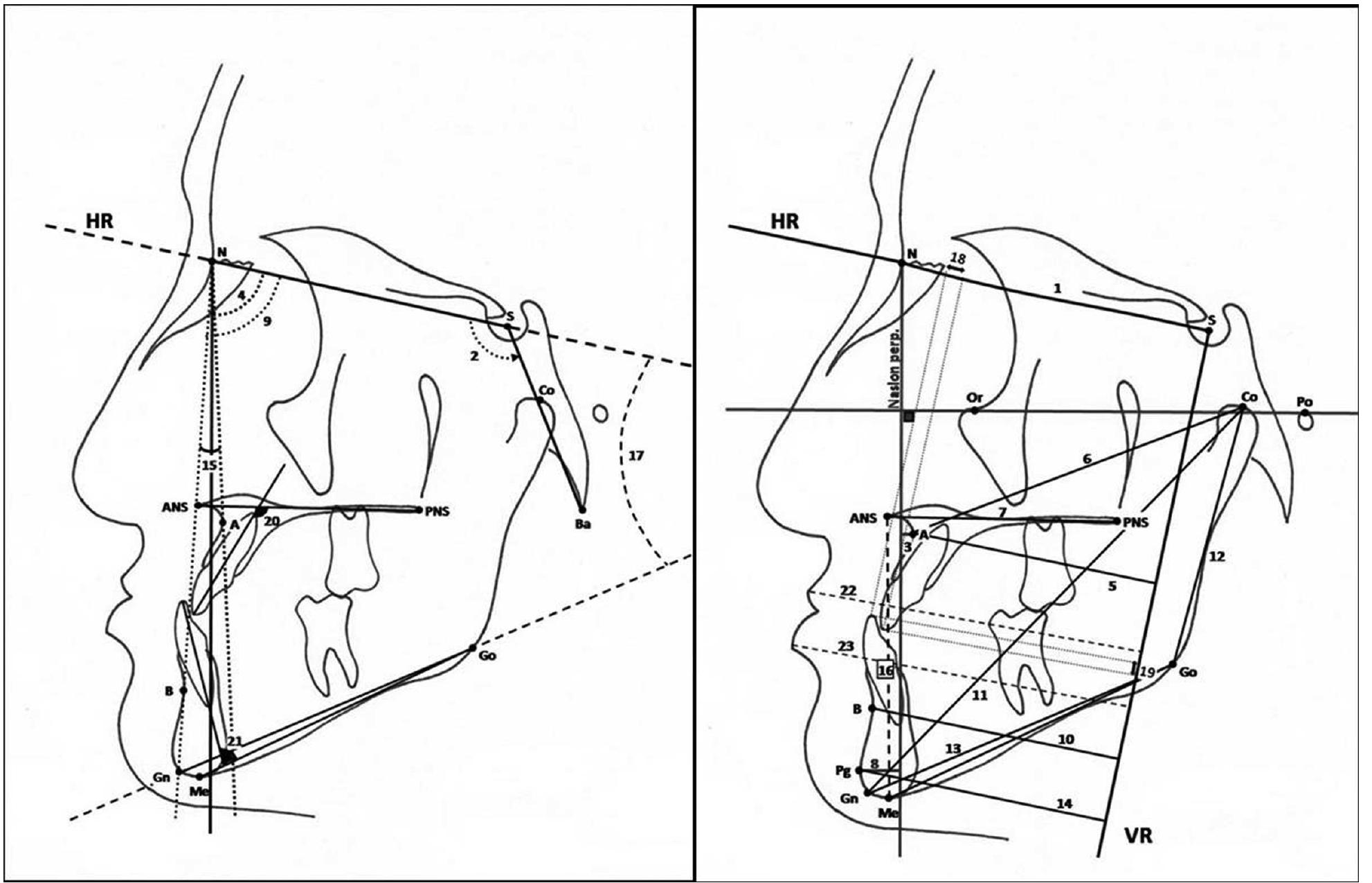 The lateral cephalometric measurements: 1: s-n (cranial