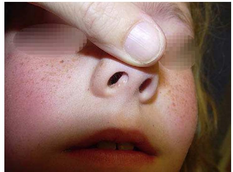 Figure 4 - from Milia: A review and classification