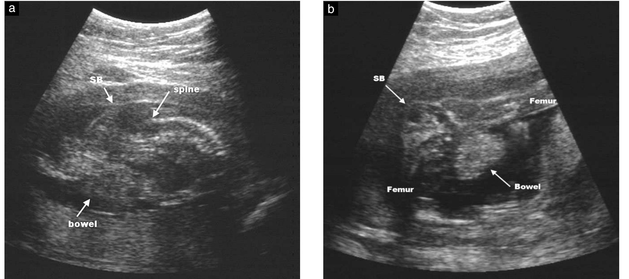 (a) case 1: sagittal dorsal view showing vertebral bodies