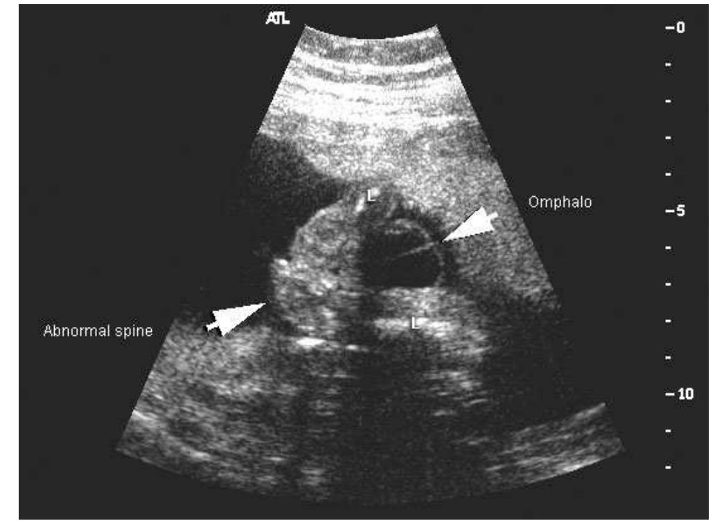 Fetus 7: transverse view across fetal lower abdomen showing