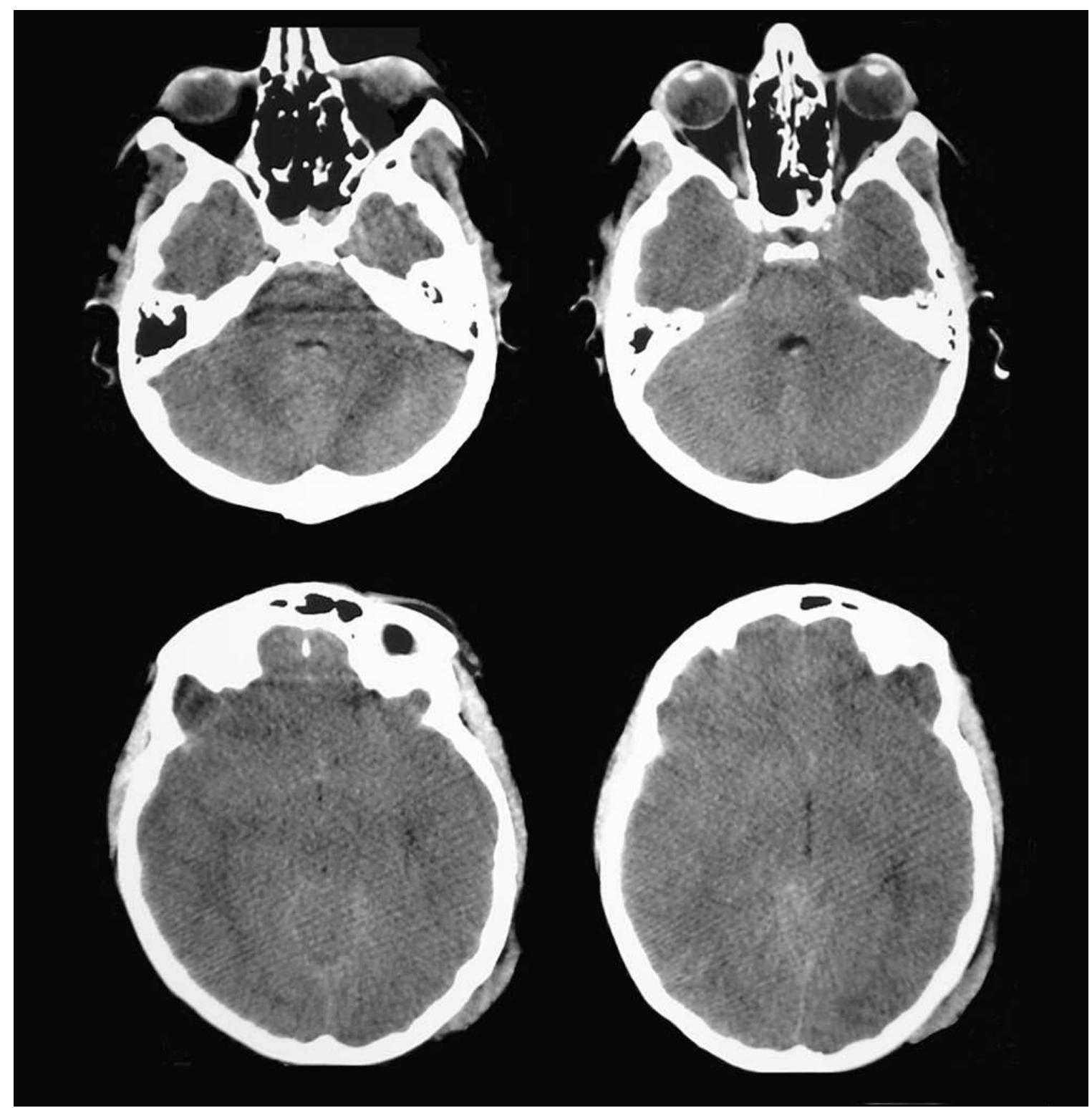 Initial brain ct of a patient with severe head trauma