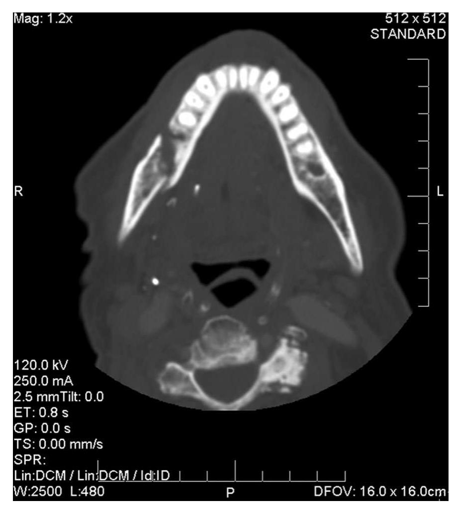 Ct scan showing the fracture of the right mandible of a