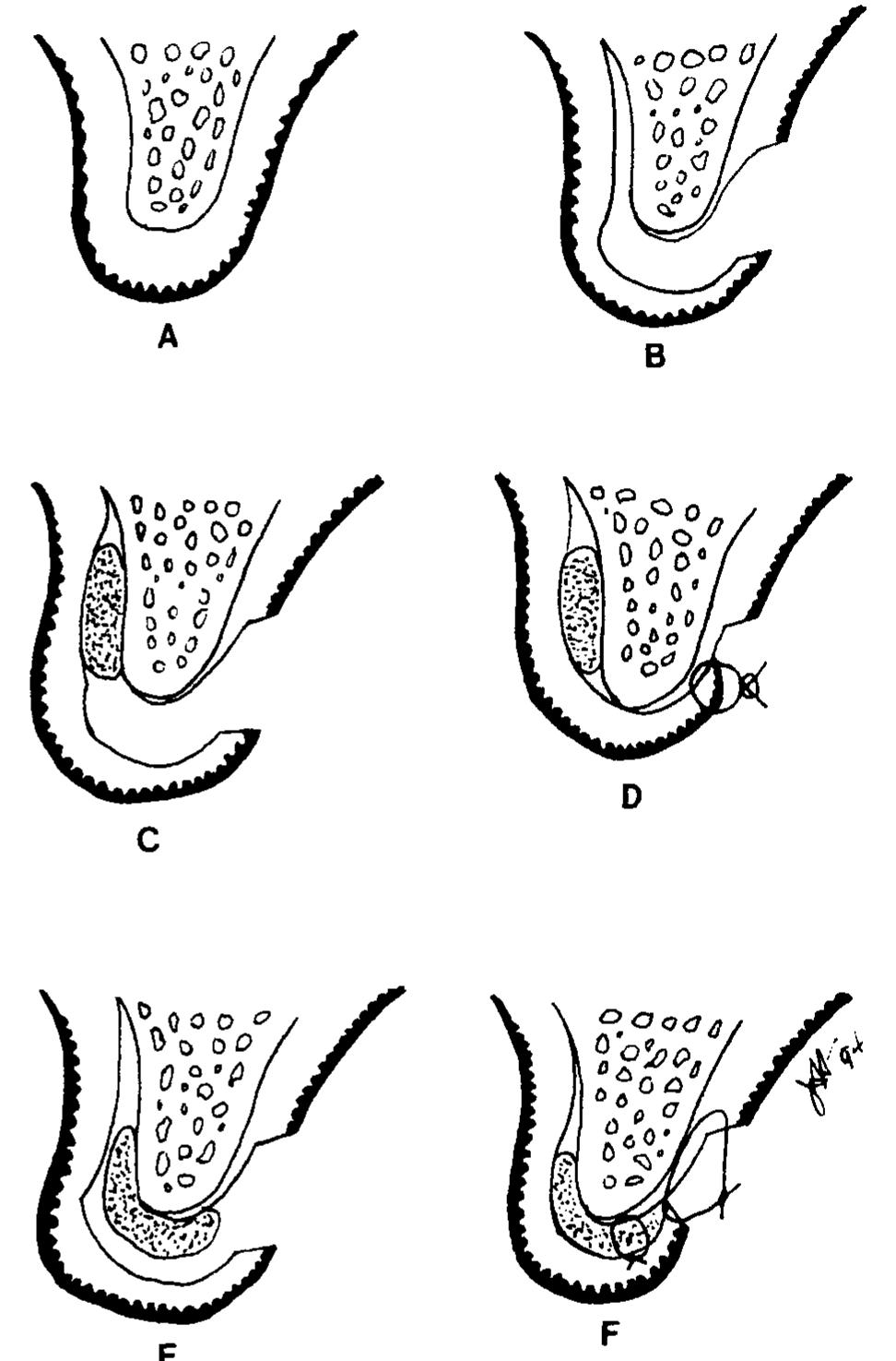 Cross-sectional diagrams for steps in pouch proce- dures. a.