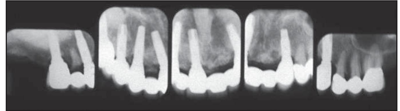 G postoperative periapical radiographs. the bone crest