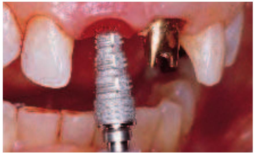 A stepped-tapered frialit®-2 implant is inserted after