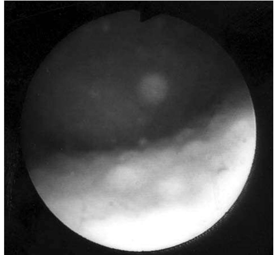 Flexible cystoscopy: the mucosal surface of the bladder is