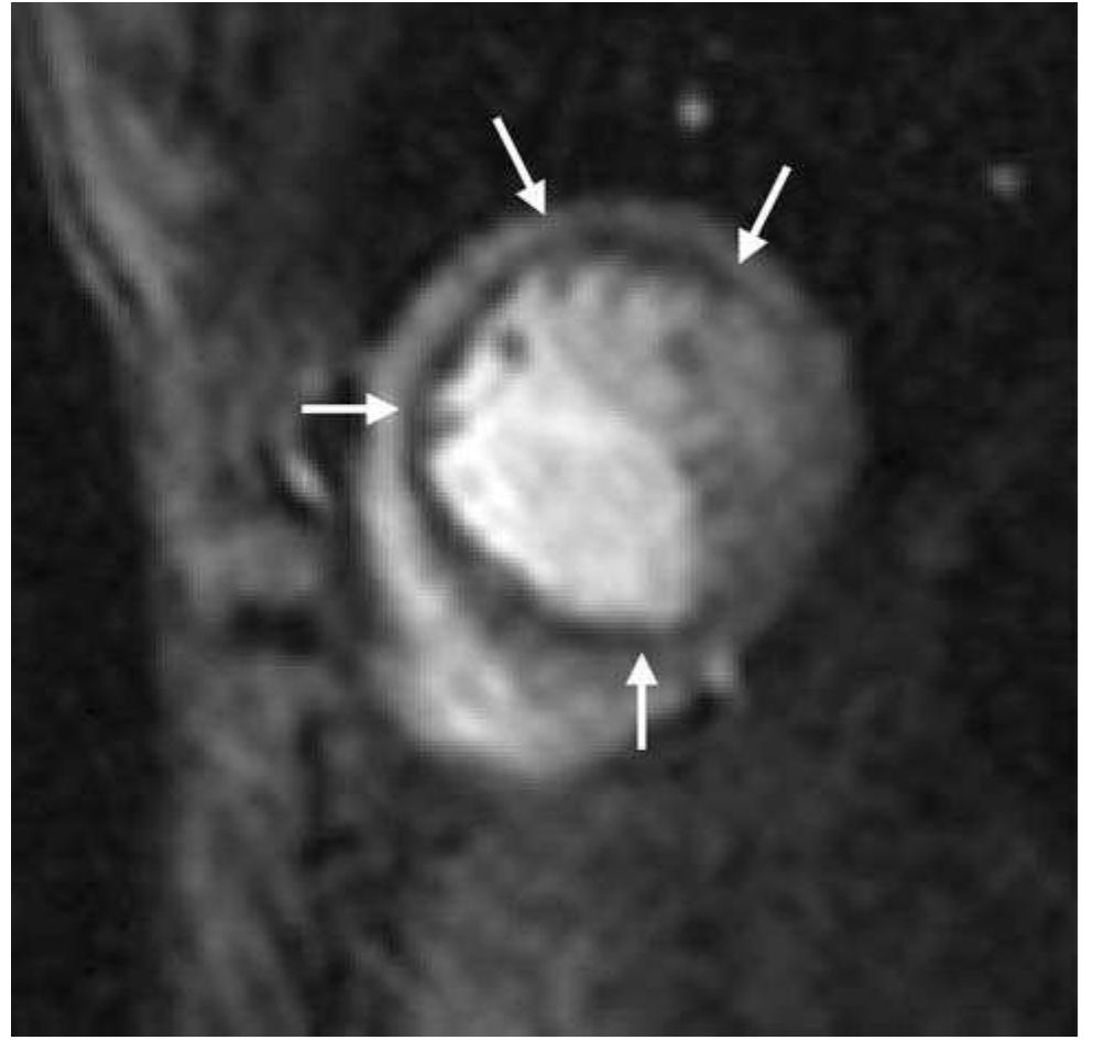 Magnetic resonance imaging scan demonstrating first-pass