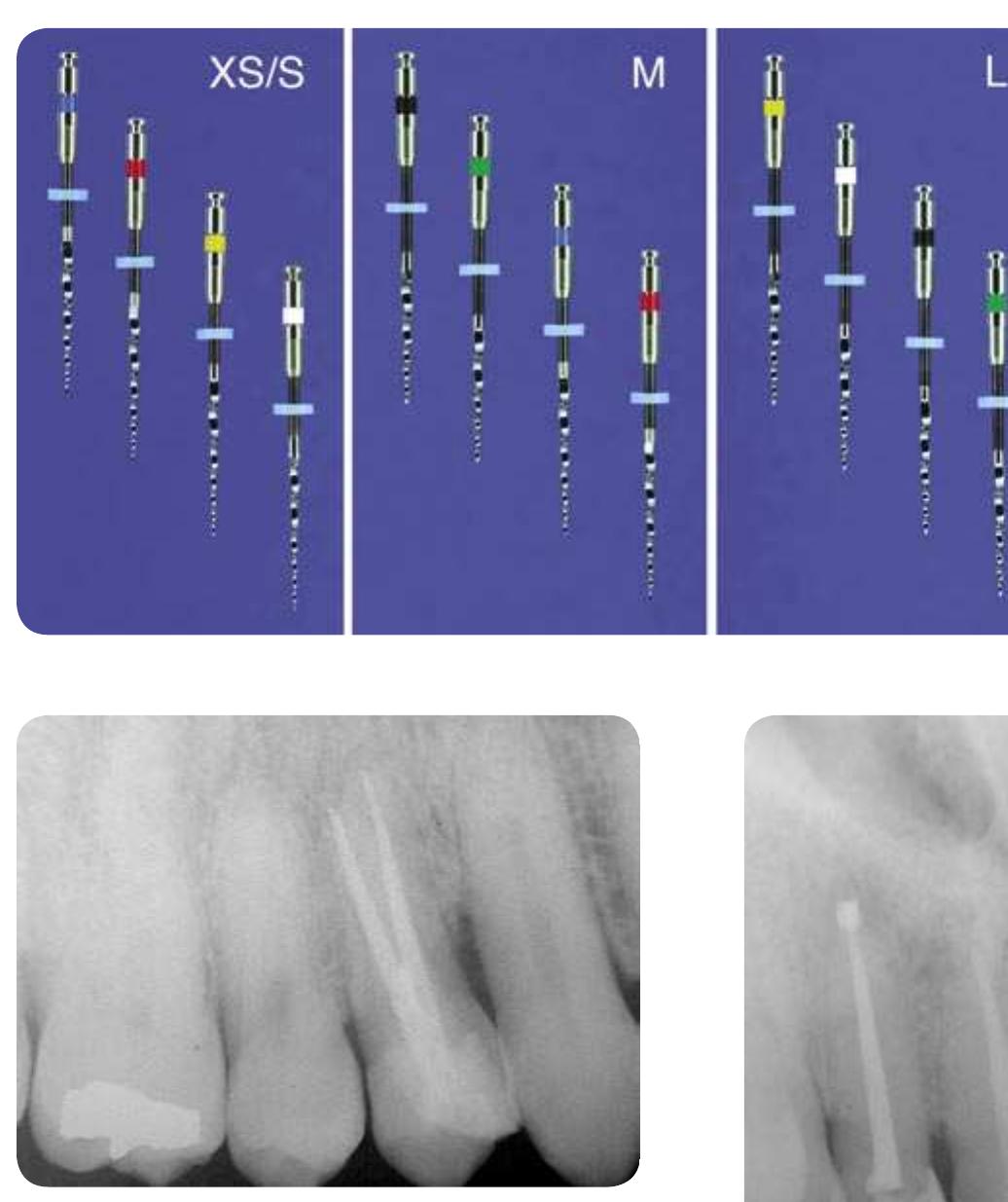 Maxillary first premolar (no. 5) instru- mented with a small