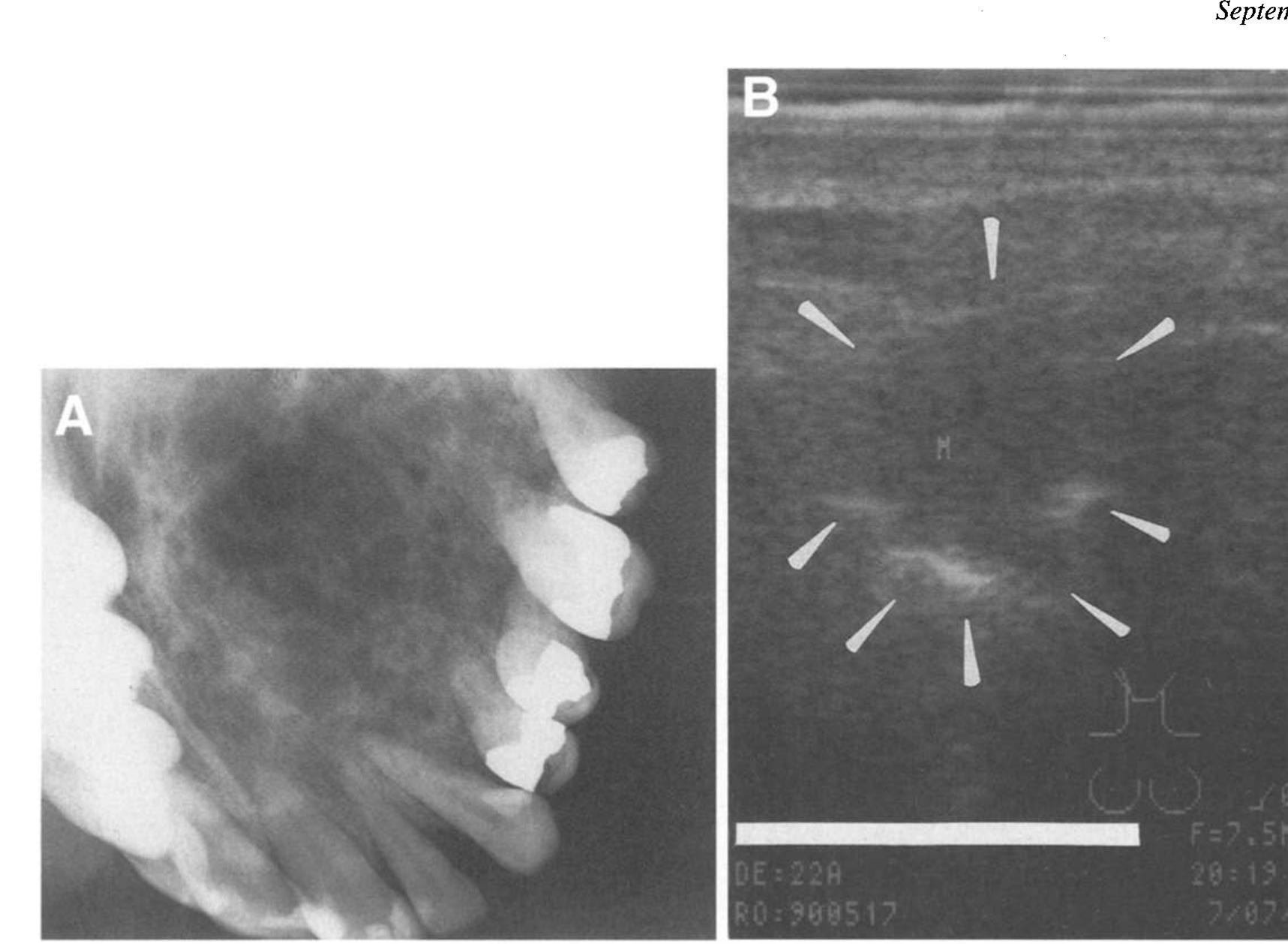 A, occlusal radiograph of follicular ameloblastoma of left