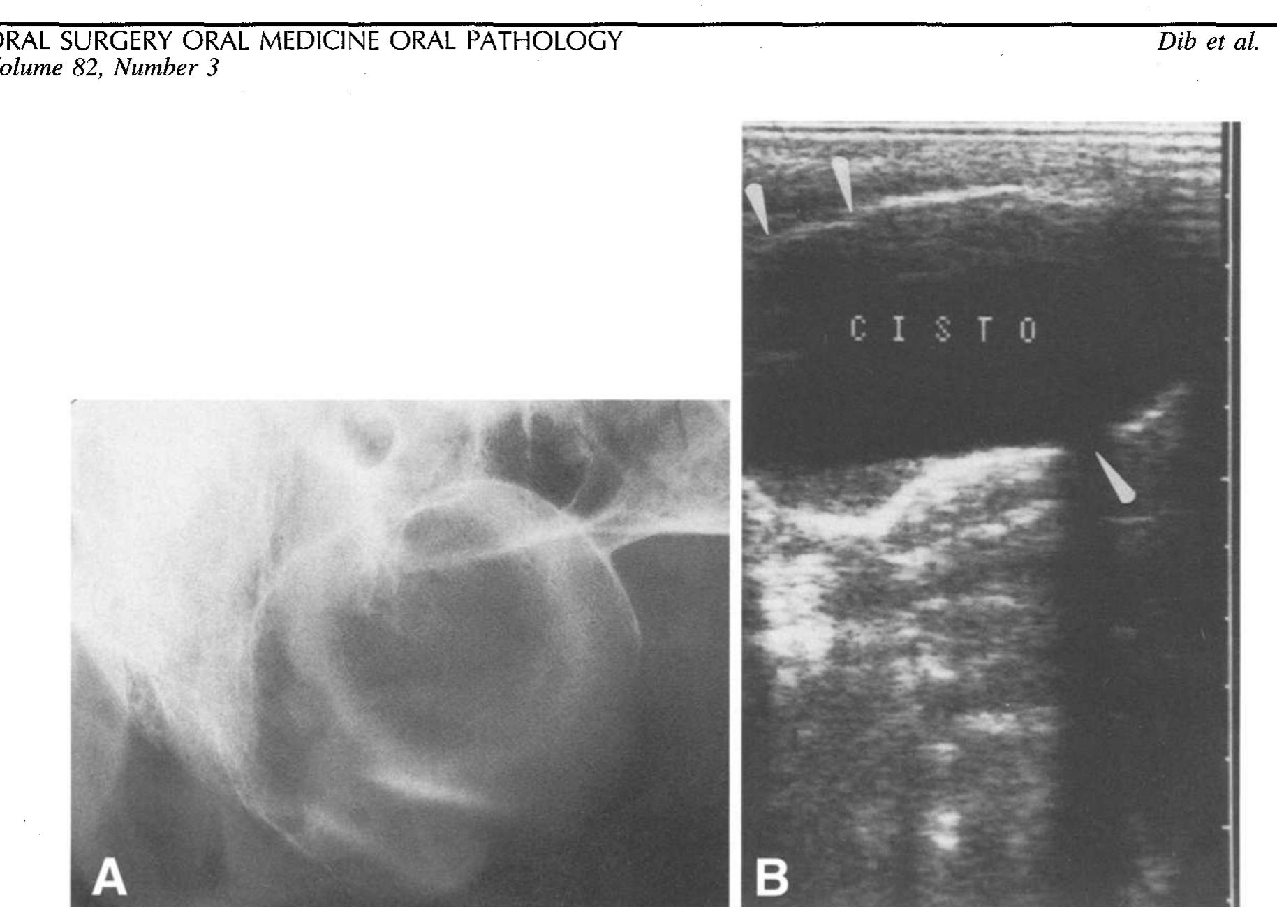 A, occlusal radiograph of radicular cyst of anterior area of