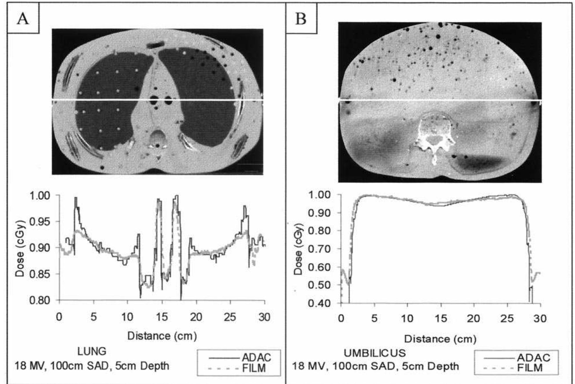 Dose profile for the lung (a) and pelvis (b) region at a