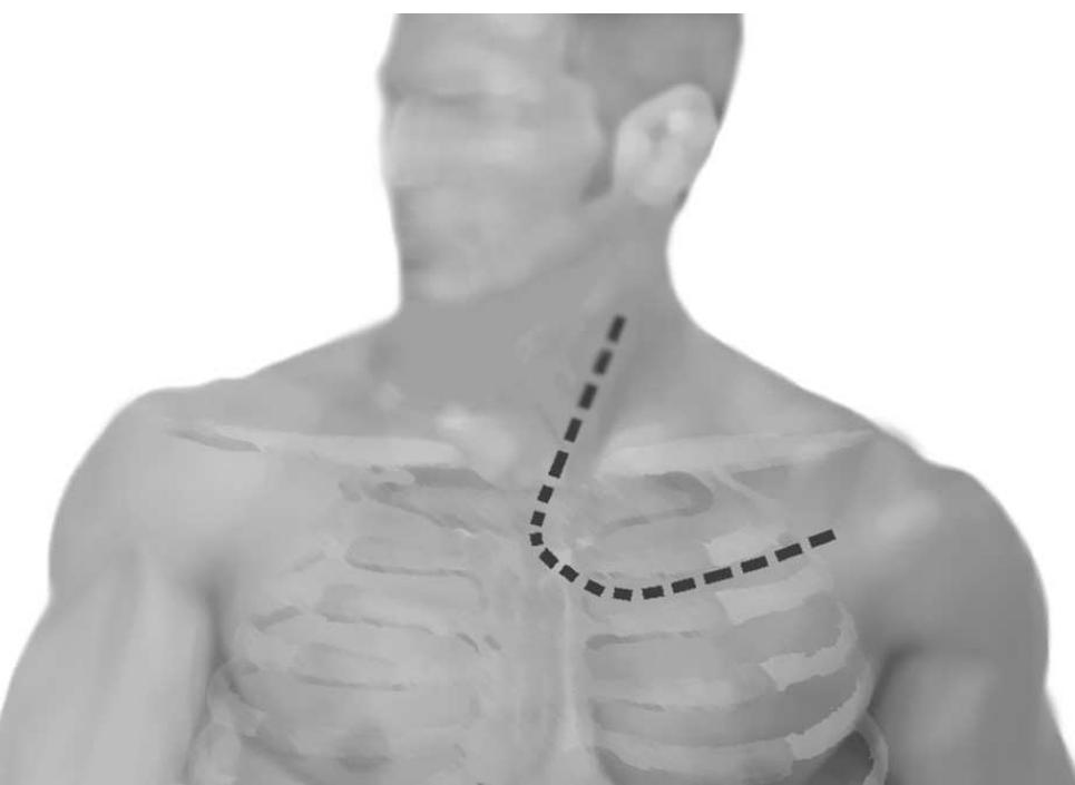 Schematic 2. cutaneous incision.