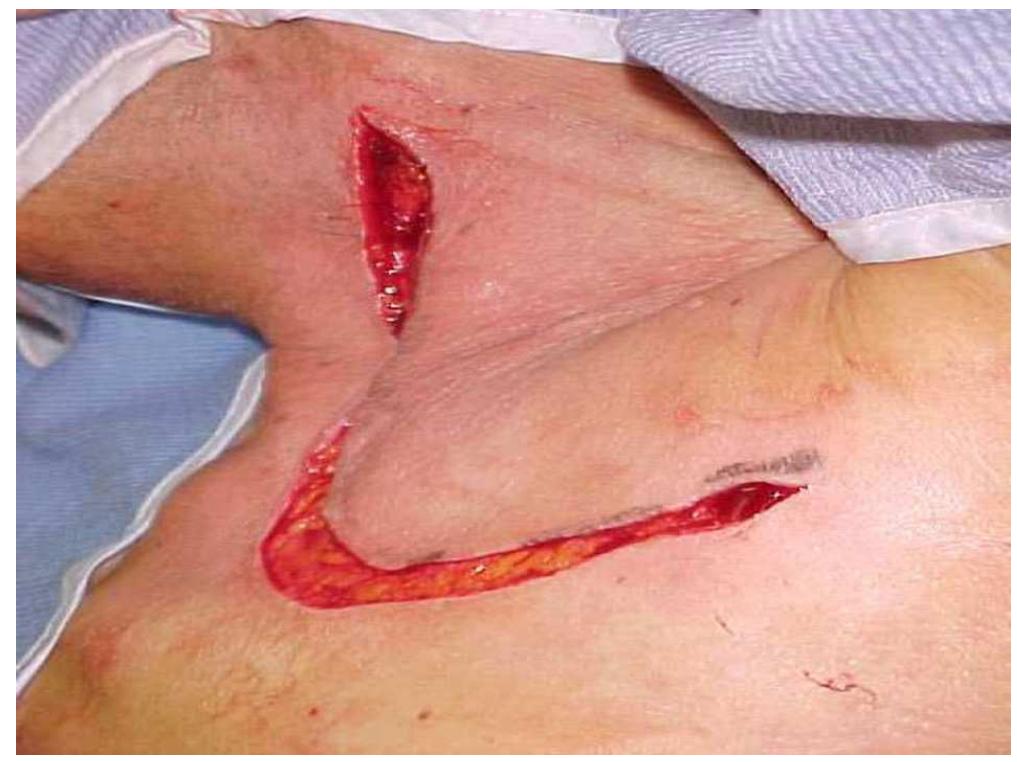 Photo 5. cutaneous incision of the tma approach.