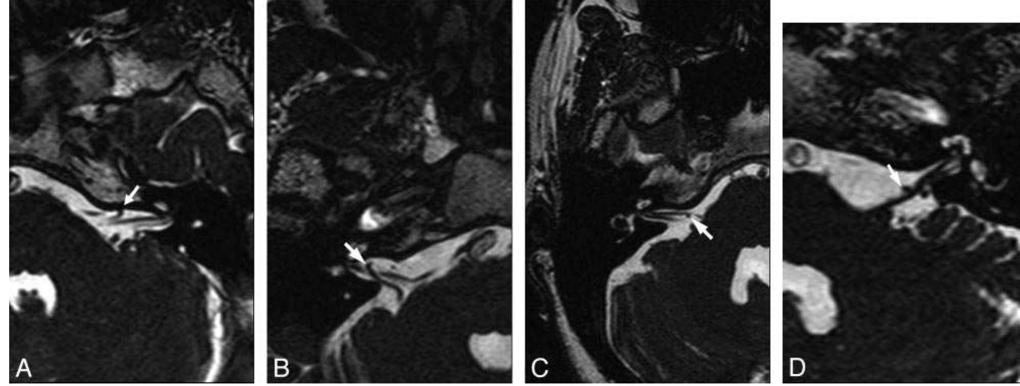 Examples of types of aica loops and eighth cn-aica