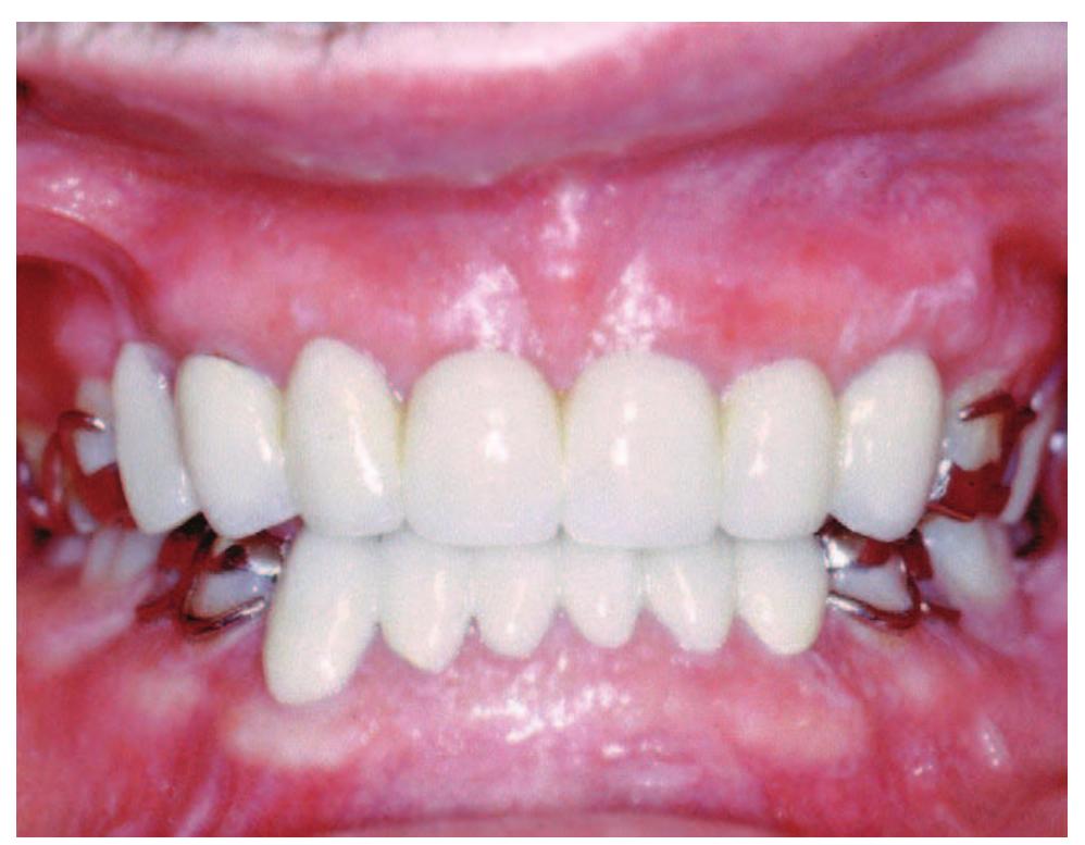 Intraoral anterior view of restored maxillary and mandibular