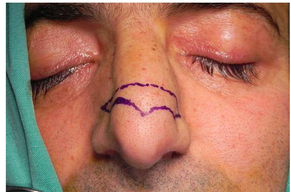 Skin marking of “wodar’ incision