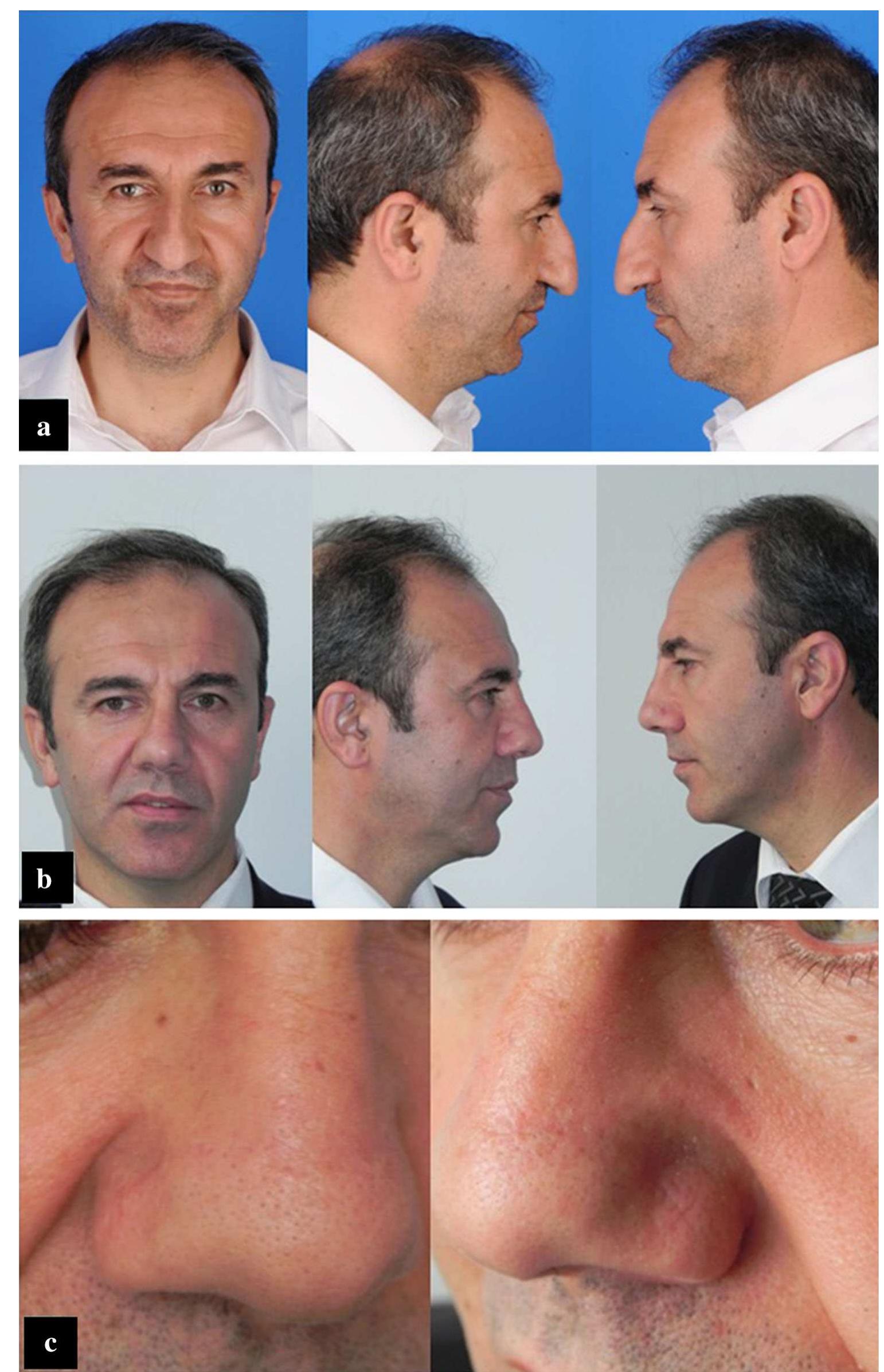 Droopy nasal tip with acute nla