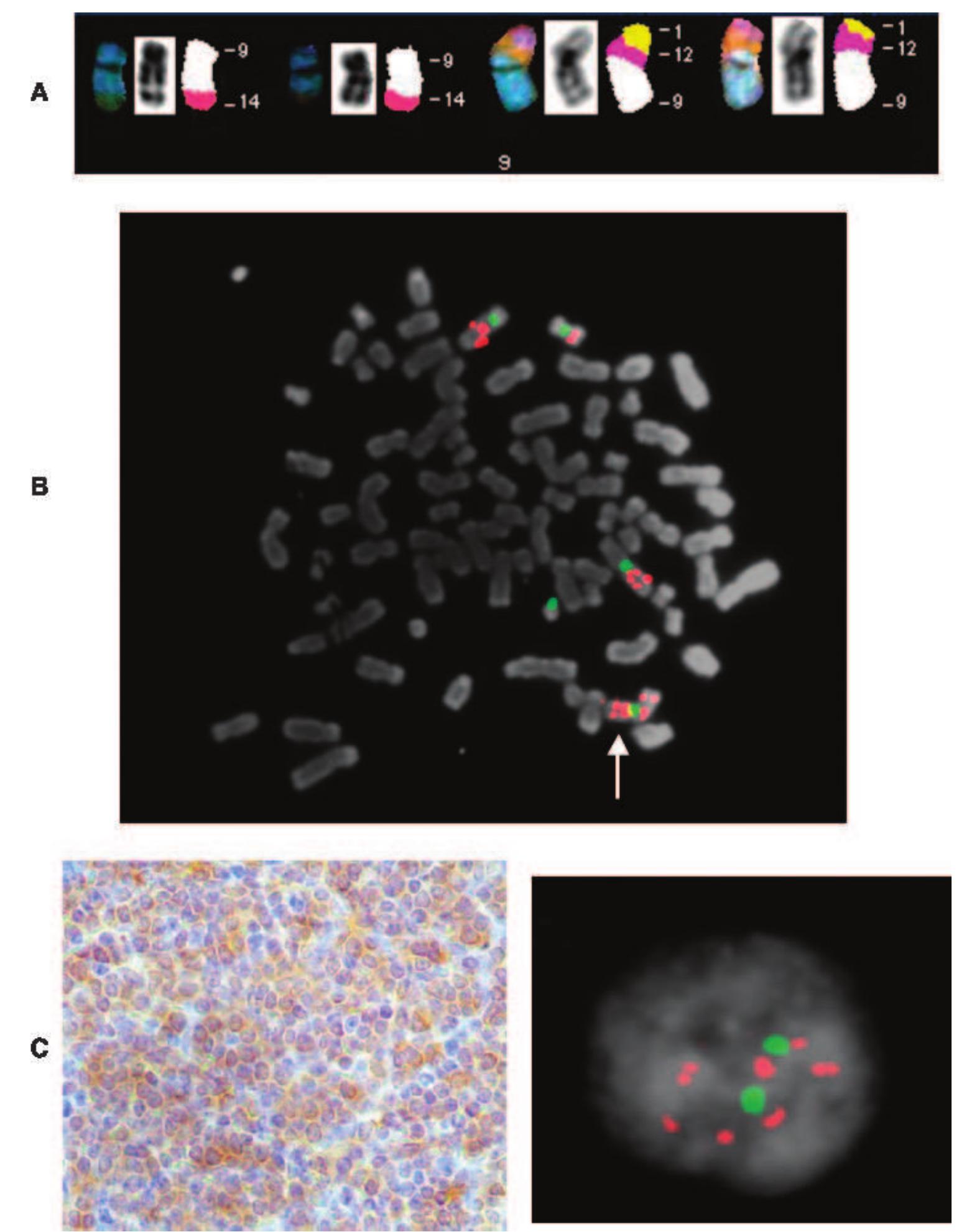 Fluorescence in situ hybridisation (fish) showing gain of