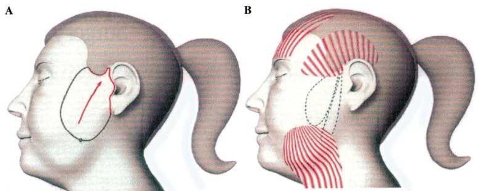(a) with a simple minimal access cranial suspension lift, a