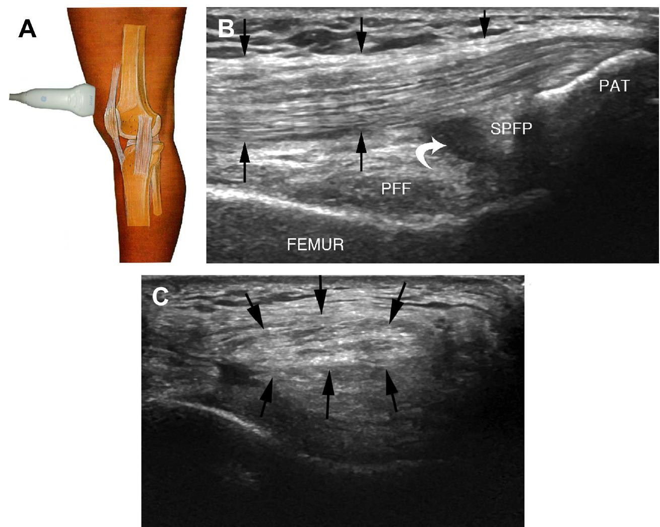Normal quadriceps tendon. (a) normal positioning of the
