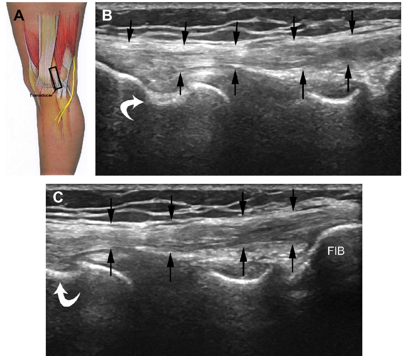 Figure 5 - from Ultrasound of the Knee