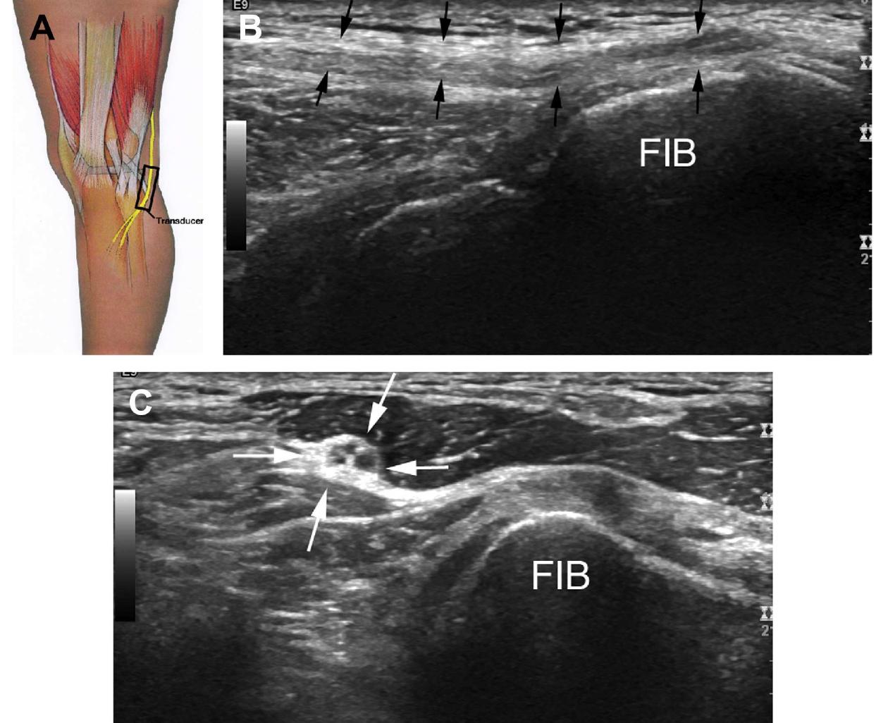 Common peroneal nerve. (a) normal positioning of the
