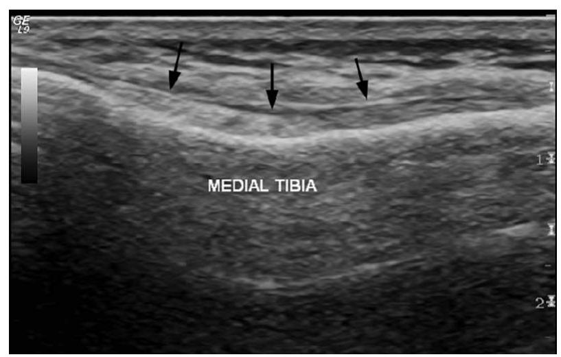 Normal pes anserine tendon _ insertion (arrows). failure,
