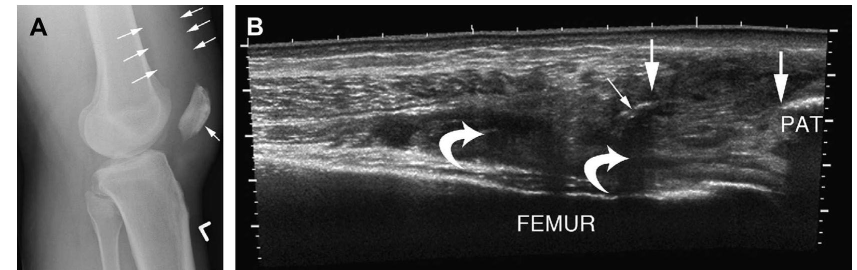 Quadriceps tendon tear. (a) lateral radiograph of the knee