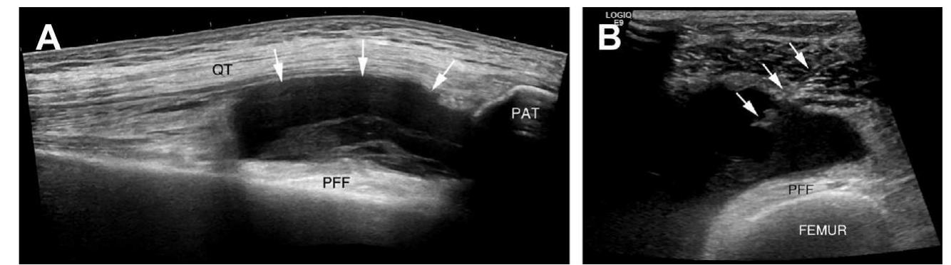 (a) longitudinal image through the knee shows a markedly