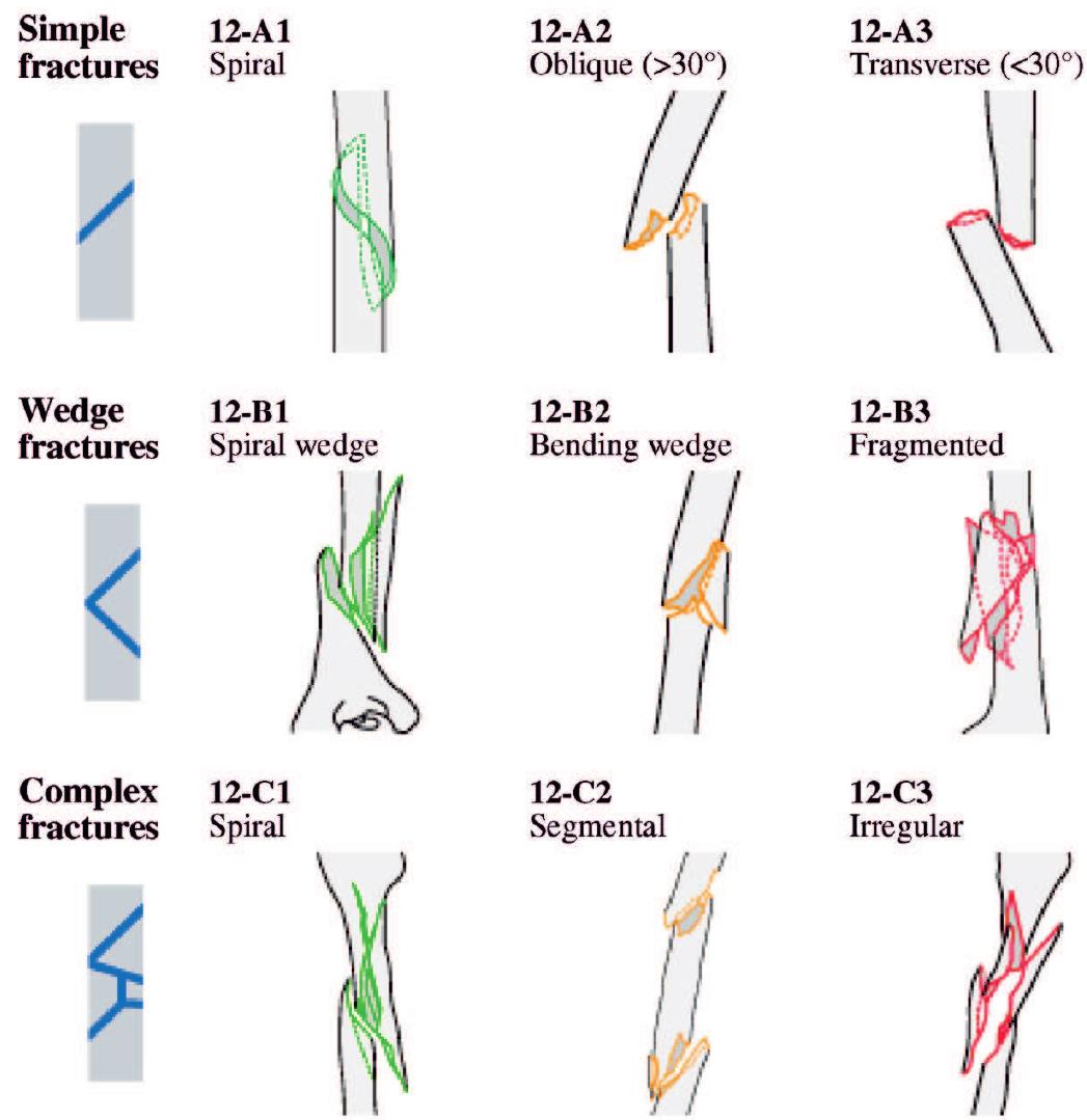 Ao-classification of humerus shaft fractures accor- ding to
