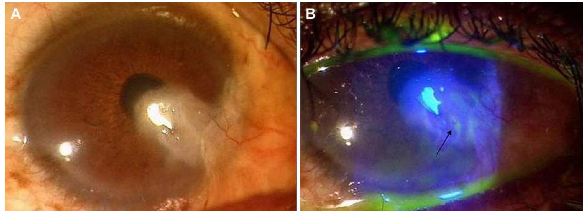 Slitlamp photograph of a corneal perforation (a) with a