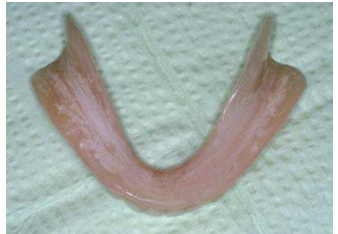 Intaglio surface of mandibular complete denture shows