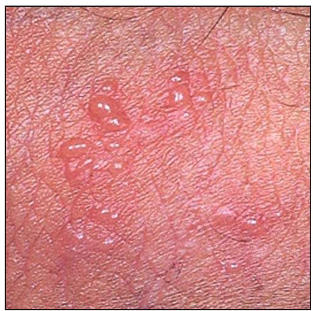 Herpes simplex vesicles. typical herpes lesions with groups
