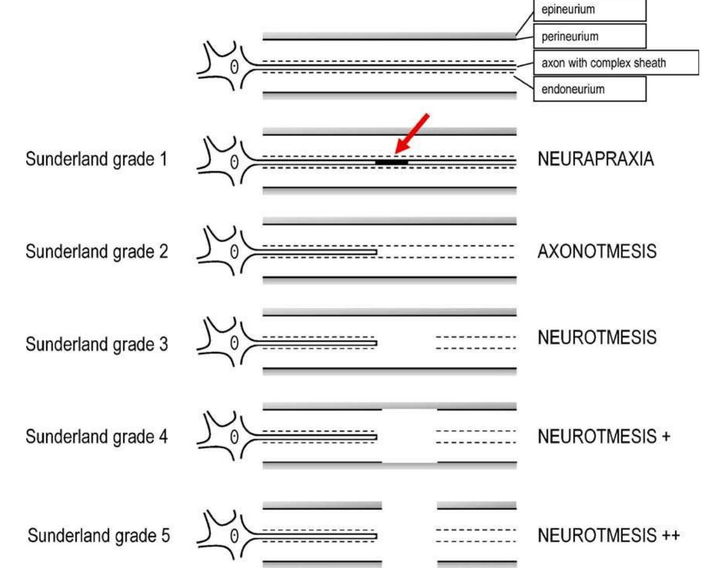 Schematic representation of the five degrees of nerve injury