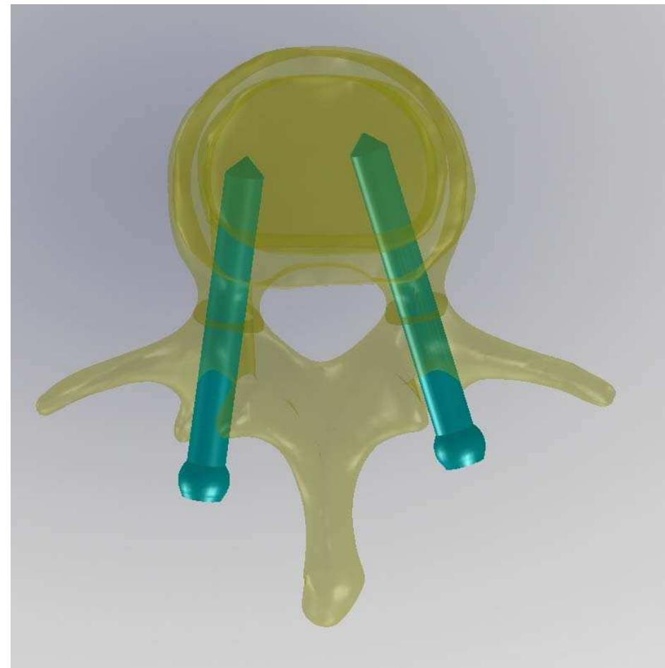 Inserted screws in solidworks since, surgical drill guide