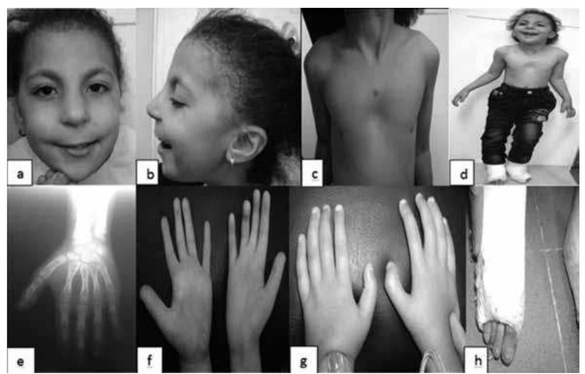 Figure 1 - from Terminal 2q deletion and partial trisomy