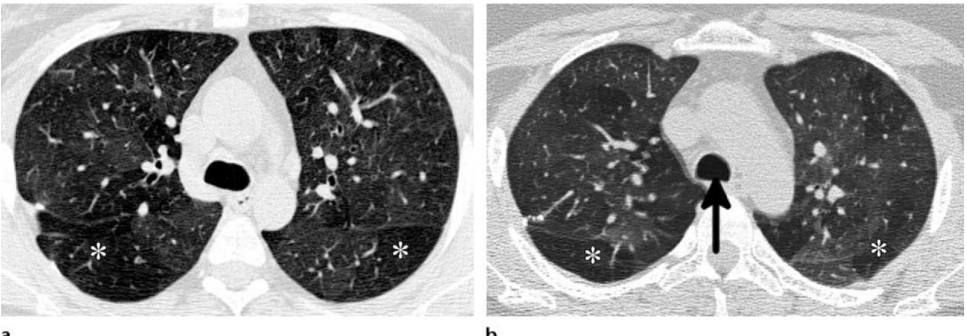 Airtrapping due to constrictive bronchiolitis in a