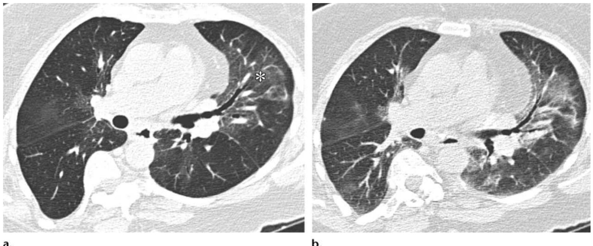 Inspiratory and expiratory ct in a 55-year-old woman with