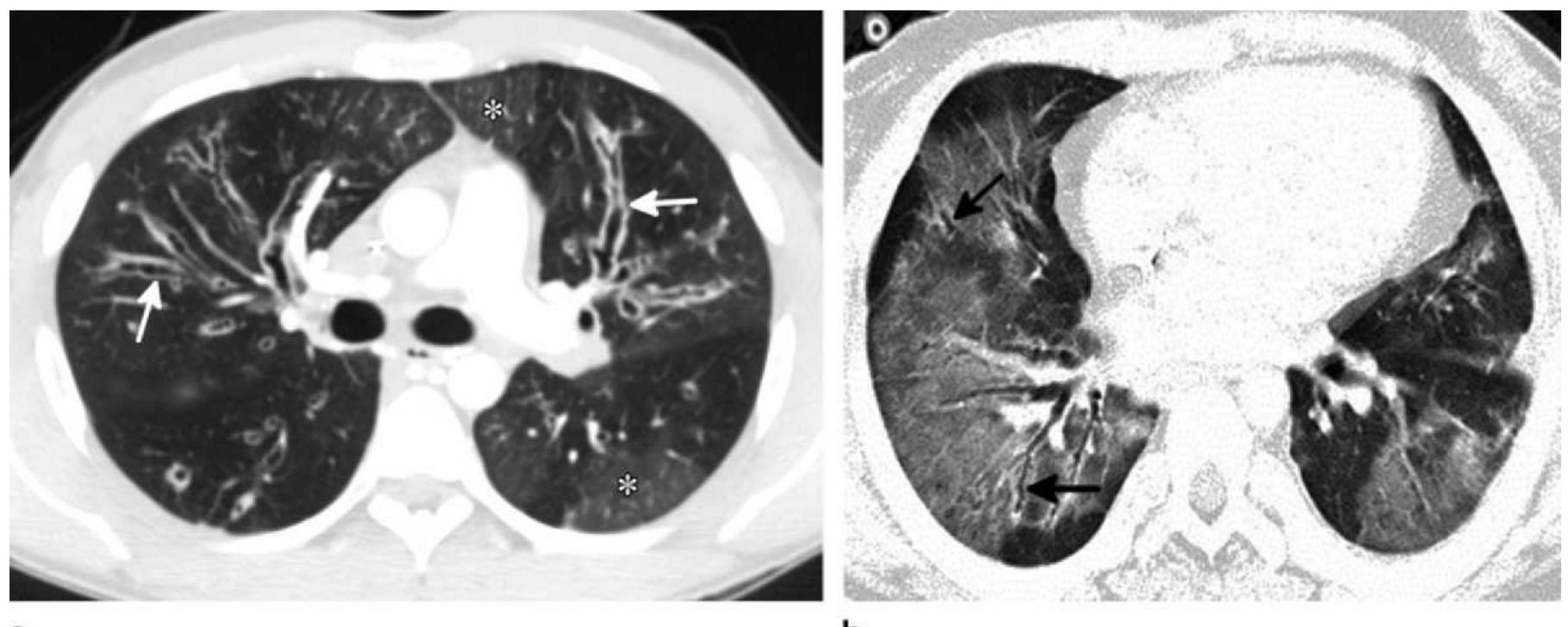 Distribution of abnormal airways in two patients with mosaic
