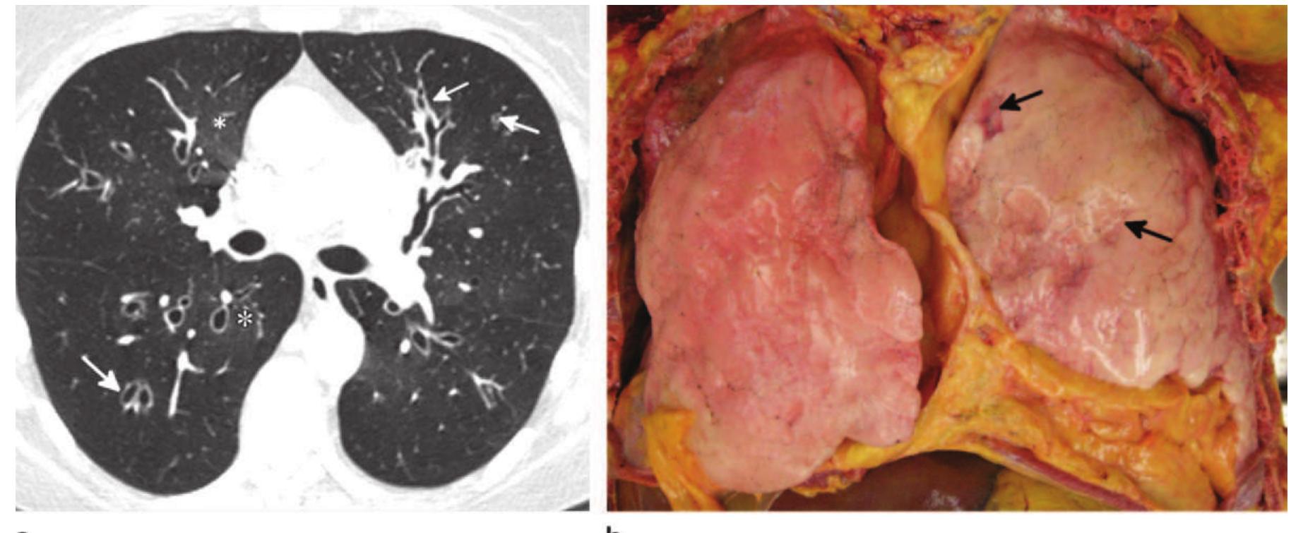 Constrictive bronchiolitis in a 72-year-old woman with