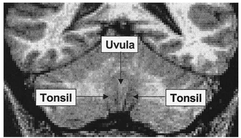 Illustration of the uvula-tonsils slice.