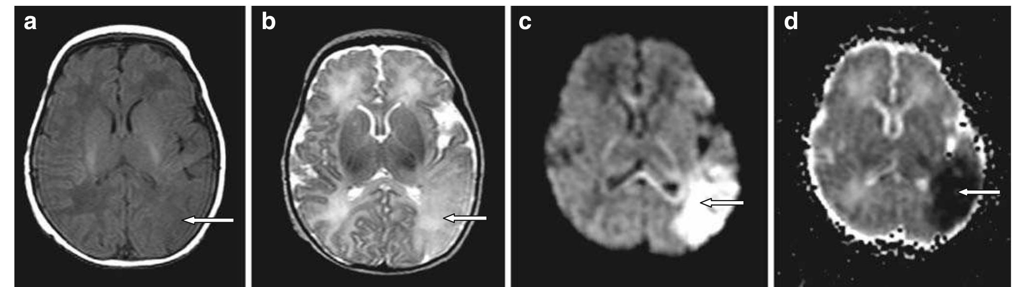 Middle cerebral artery infarct. five-day-old term born