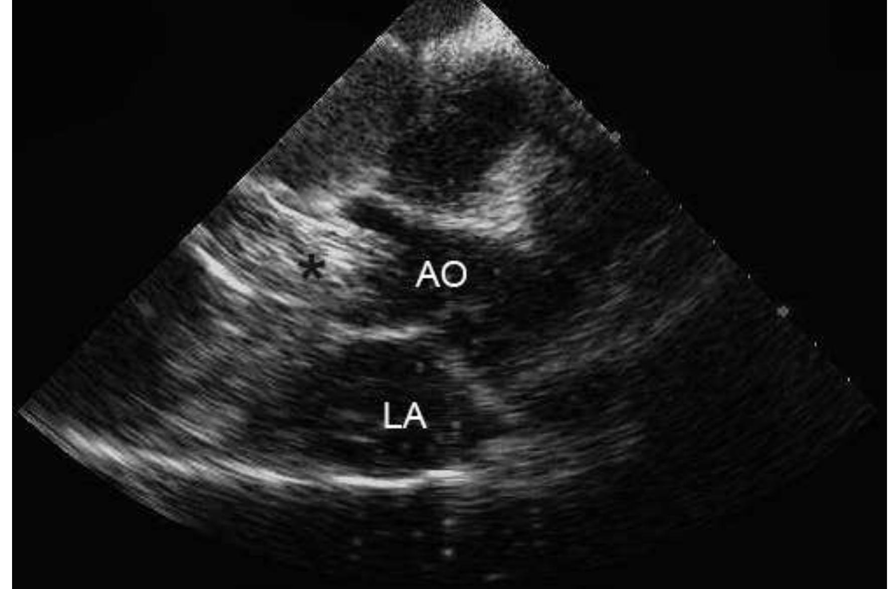 Inflation of the balloon across the aortic valve imaged with