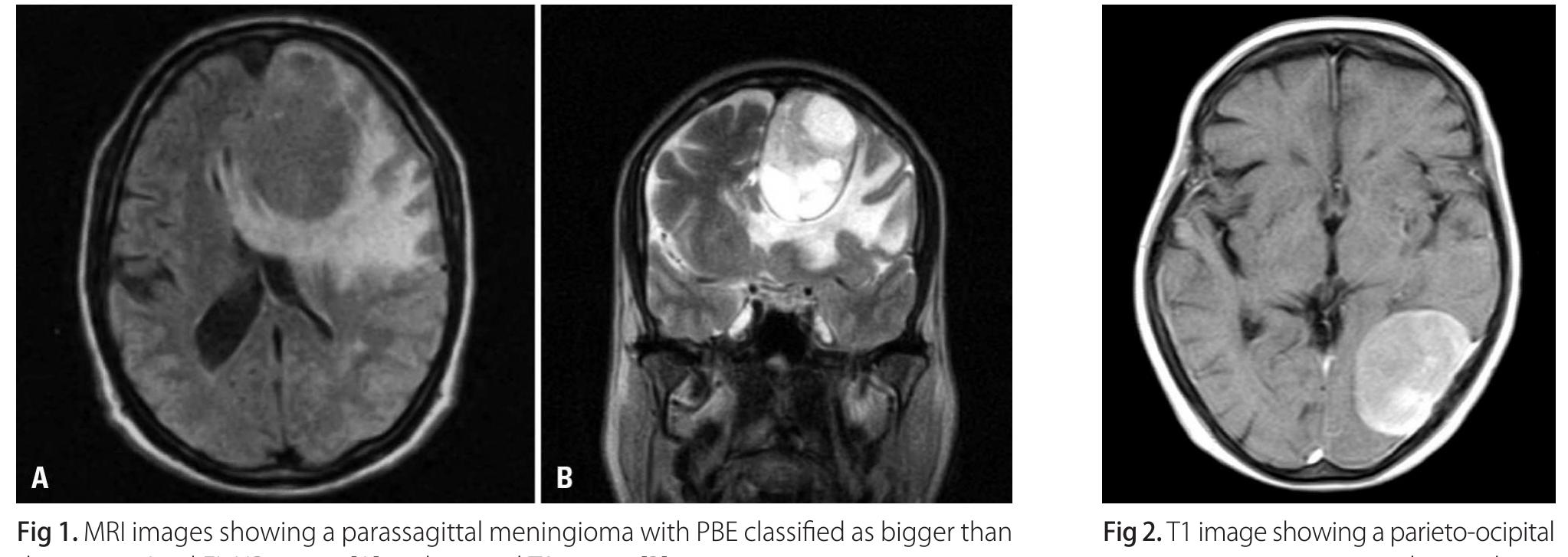 Mri images showing a parassagittal meningioma with pbe