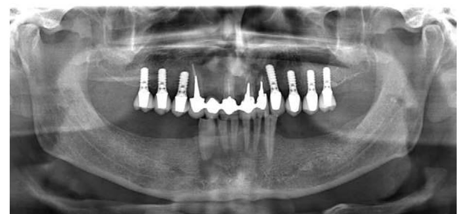 Control orthopantomogram image 1 year after early implant